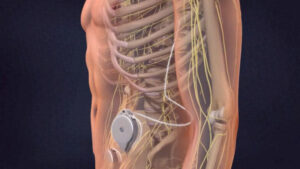 Pain pump, Intrathecal drug pump : Types , Pros and Cons - Thomas J. Hong