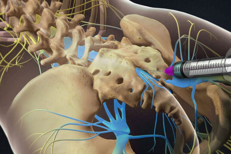 Epidural Steroid Injection (ESI) : Procedure and Success Rates – Thomas ...